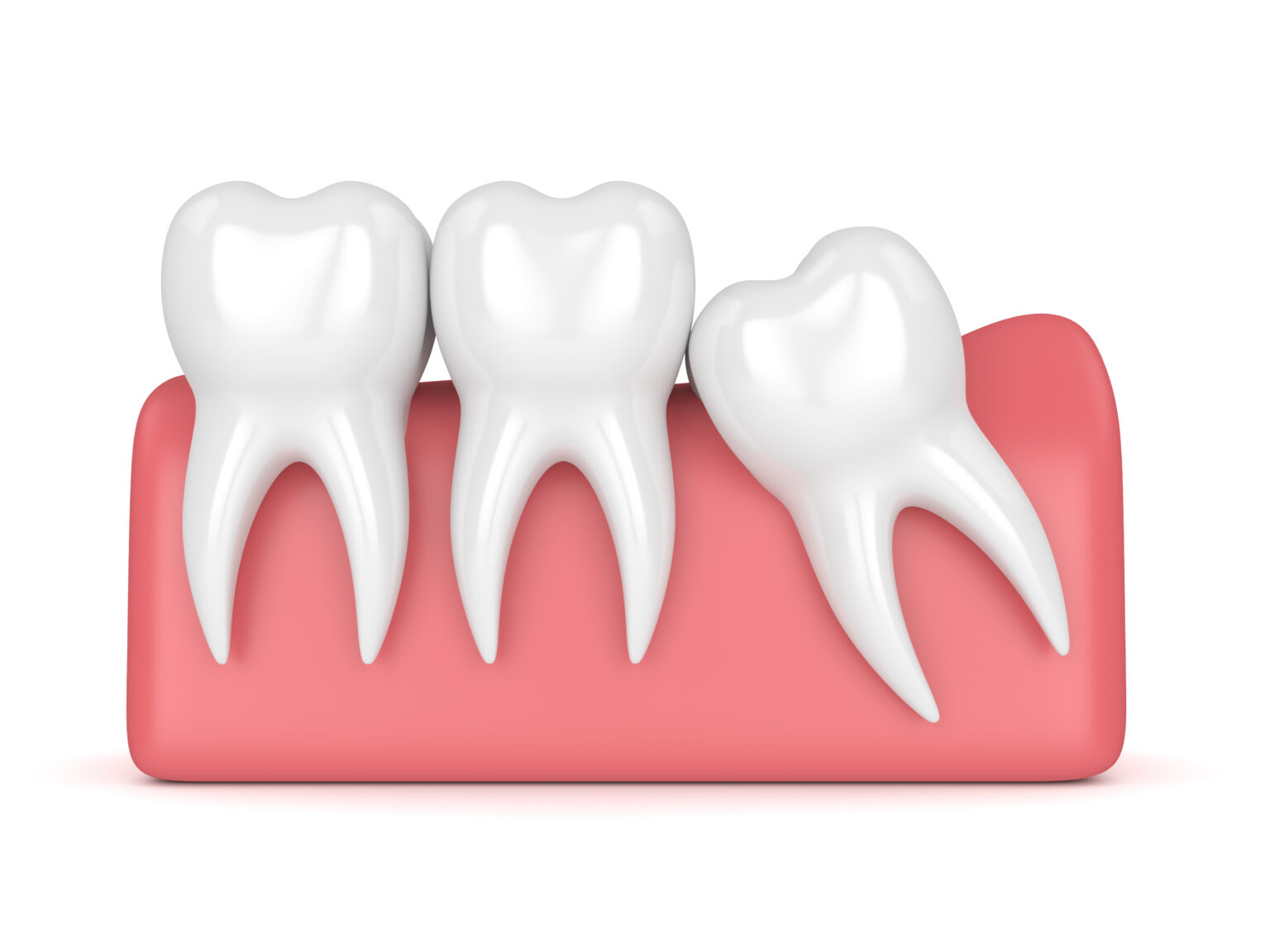 Treatment For Your Impacted Tooth